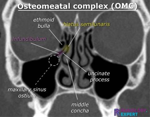 Ethmoidal Infundibulum CT Sinus